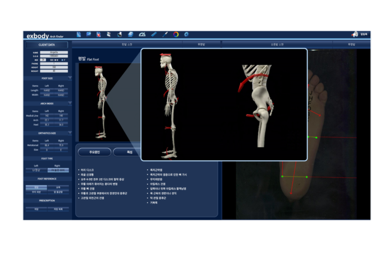 Functional Foot Orthosis - exbody | No. 1 in musculoskeletal & body ...